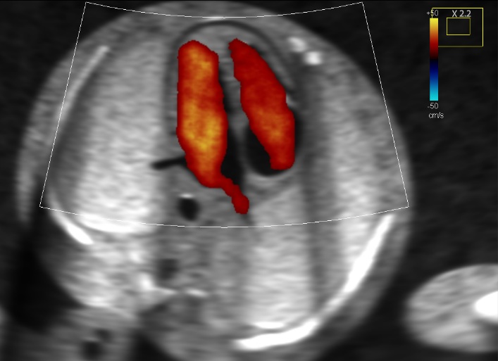 Fetal 2d Echo Test In Pune Sunrise Diagnostics Center