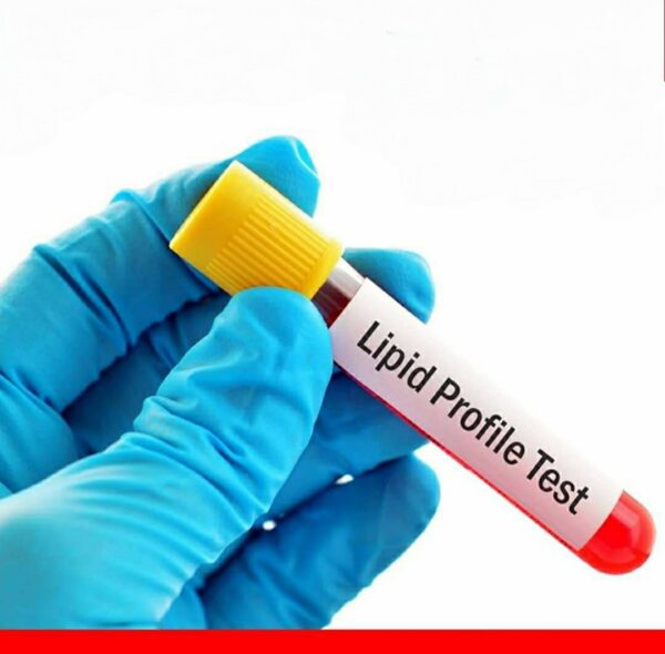 Why Would I Need a Lipid Blood Test | Sunrise Diagnostic Center