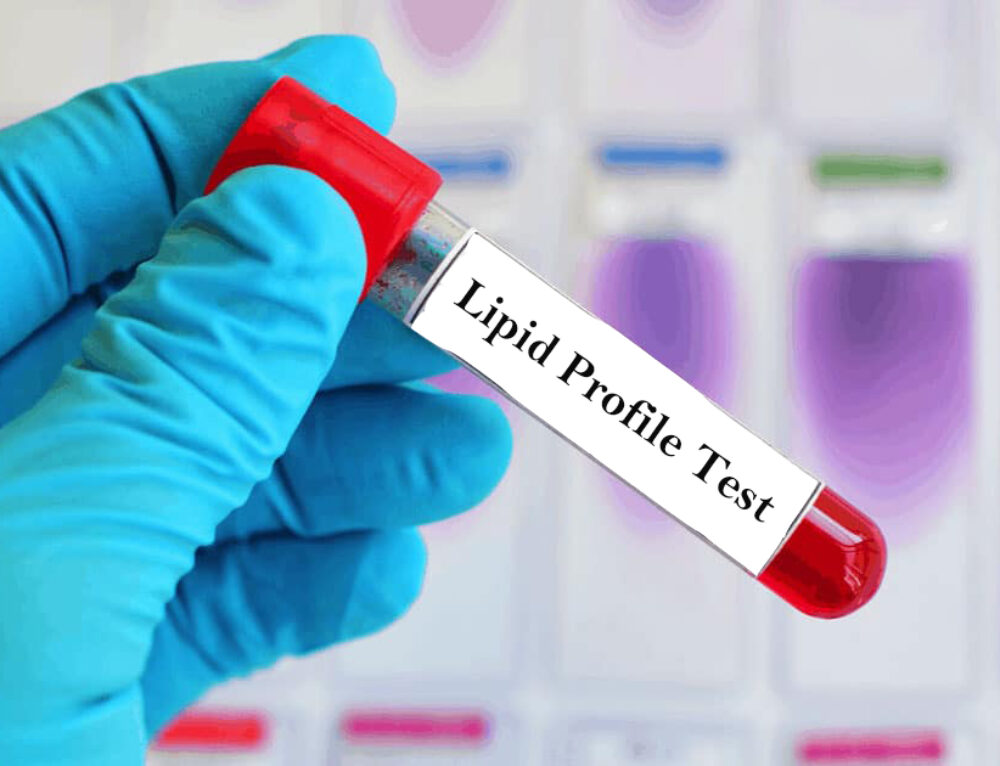 Why Would I Need a Lipid Blood Test | Sunrise Diagnostic Center