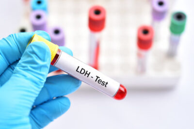 LDH Blood Test – Purpose, Normal Range & Results